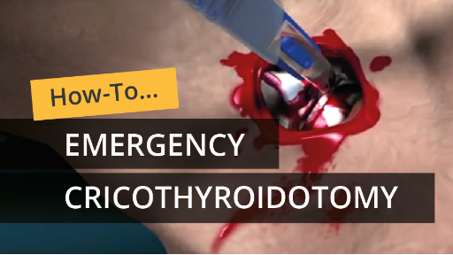 Cricothyroidotomy Vs Tracheostomy